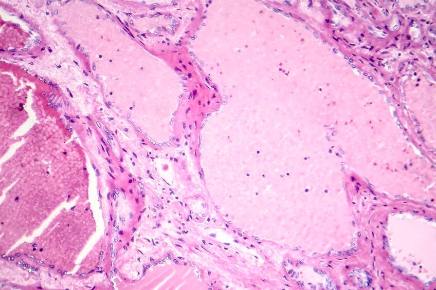 Naczyniak wątroby – co to jest? Objawy, leczenie, dieta